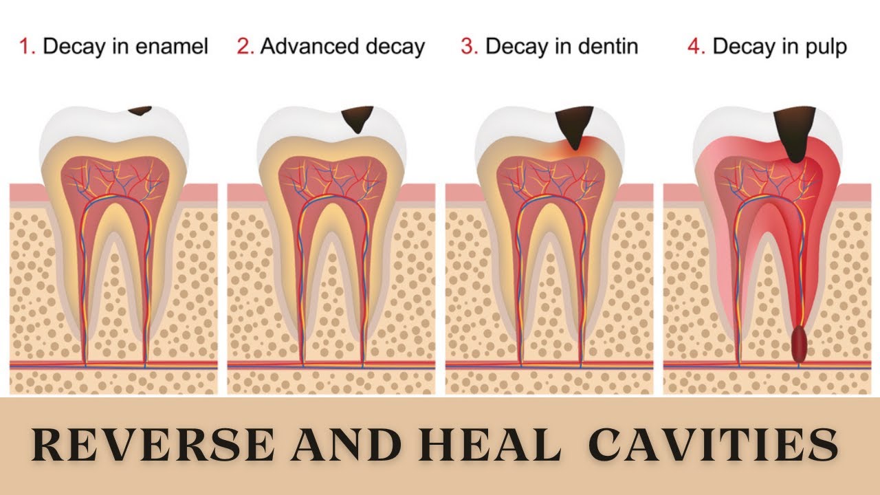 15 Ways Reverse, Prevent and Heal Cavities Naturally - YouTube