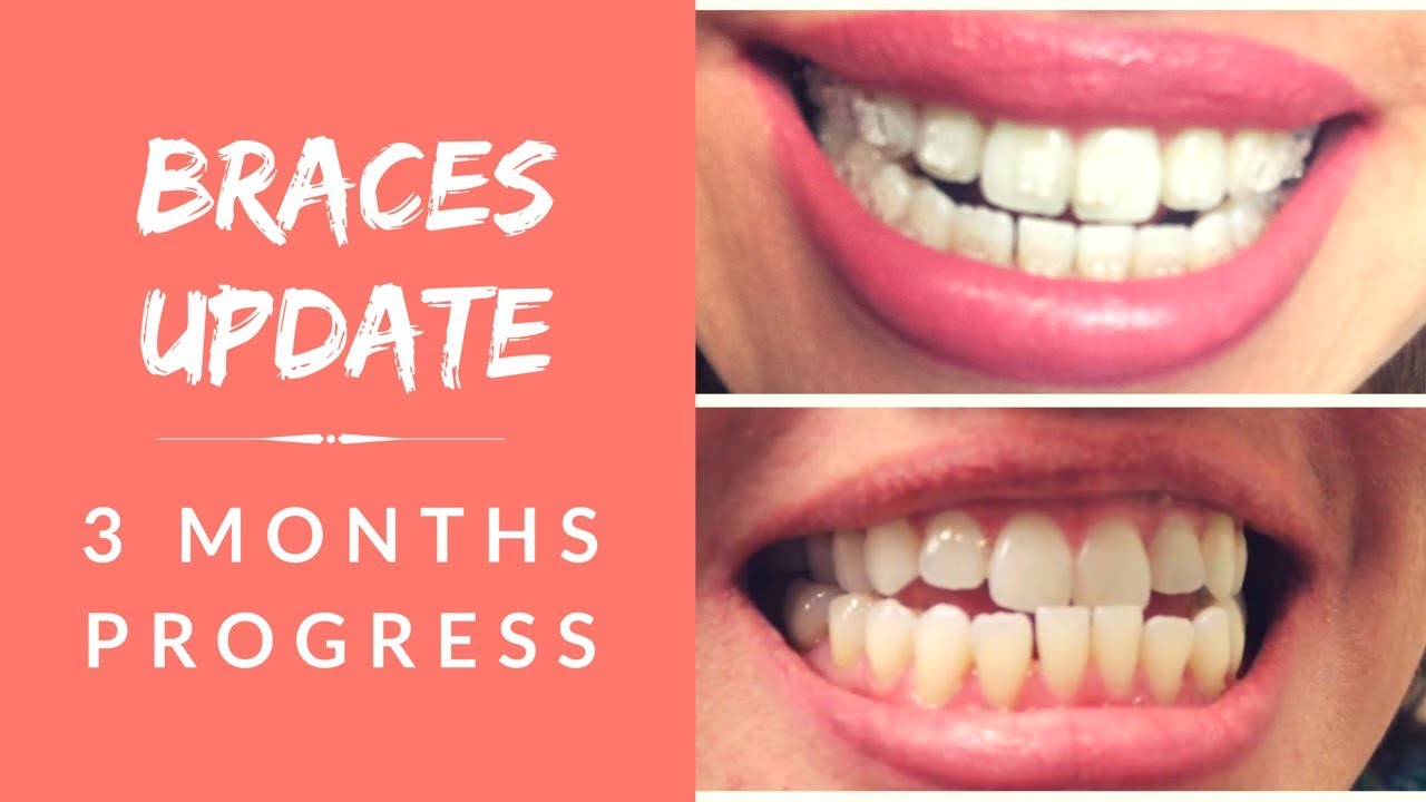 🔴live Braces Update 3 Months Progress Youtube