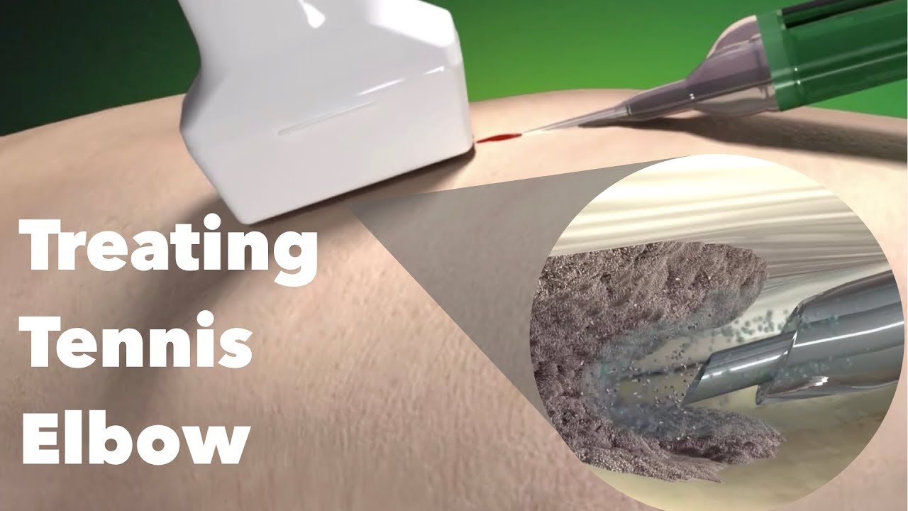 Treating tennis elbow & other tendon issues with TENEX (percutaneous ...