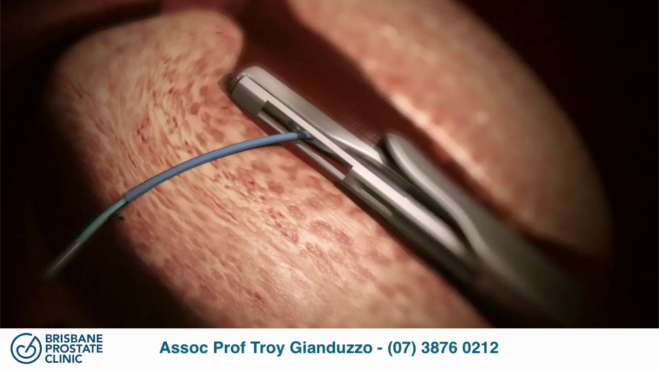 Urolift Youtube