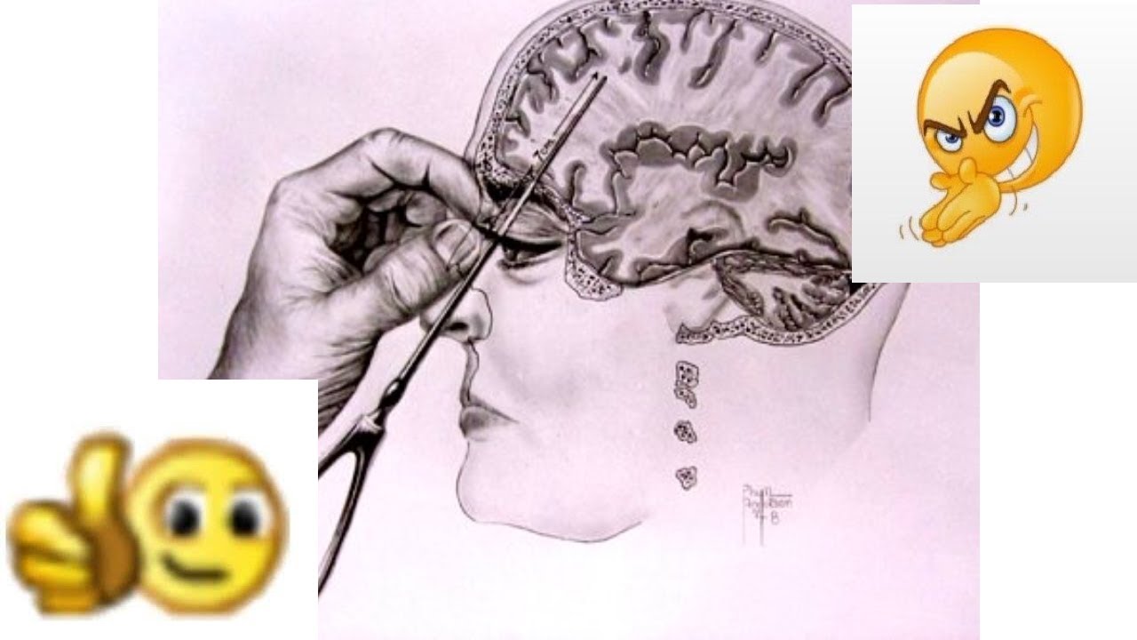 Free lobotomy easy tutorial - YouTube