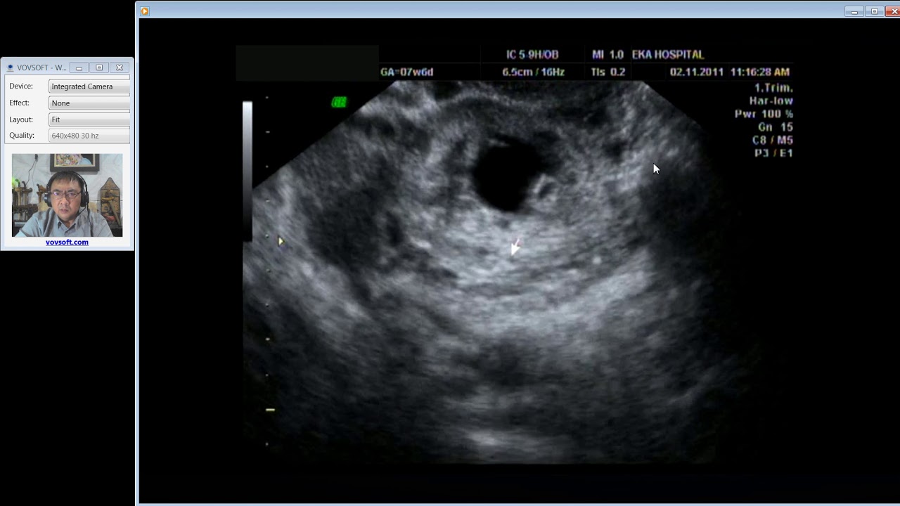 ECTOPIC PREGNANCY - KEHAMILAN DI LUAR KANDUNGAN (Dr Wiku Andonotopo ...