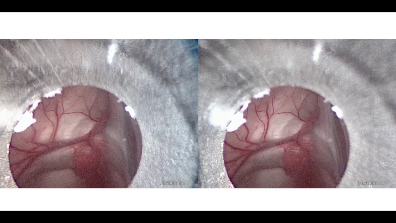 VR Ventricular Endoscopic Anatomy - YouTube