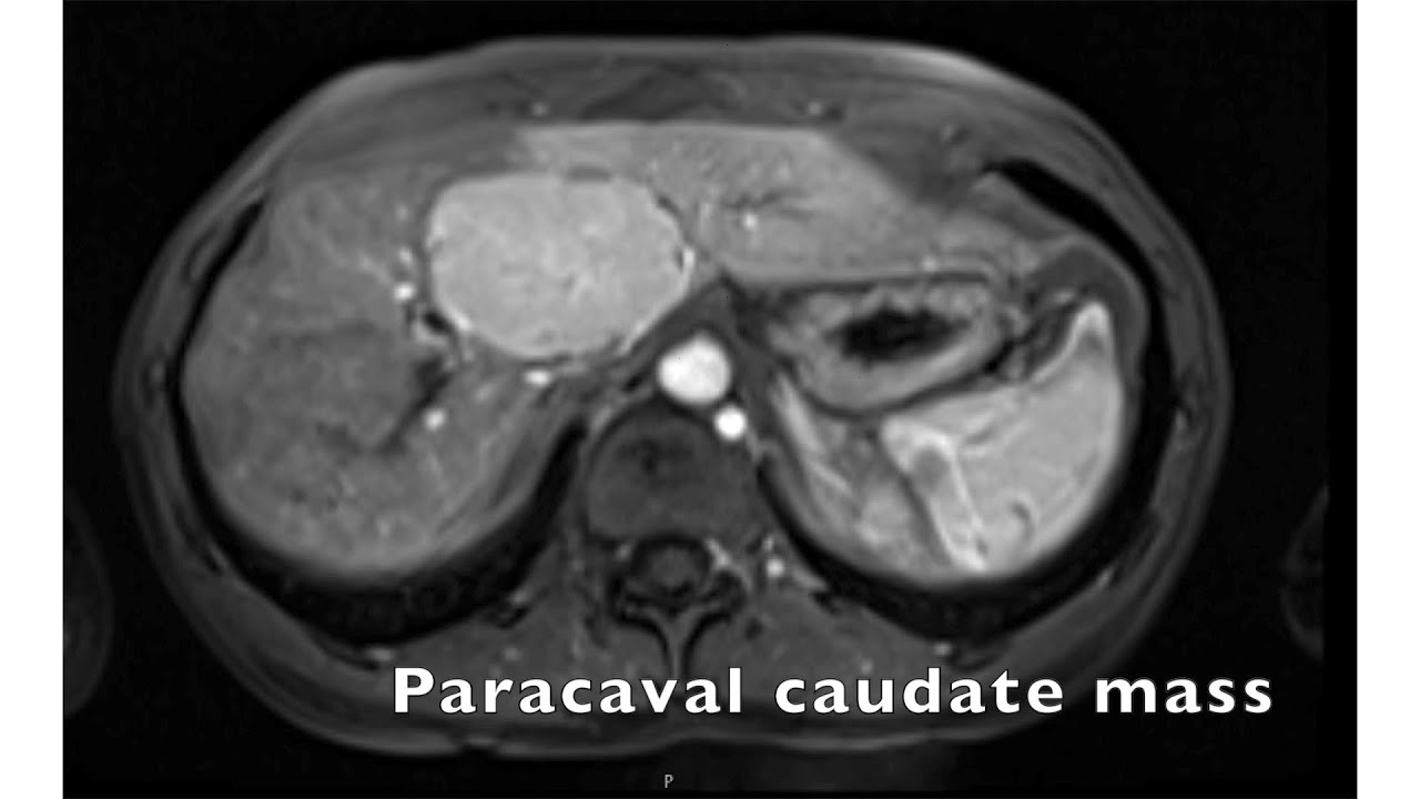 Robotic caudate resection with extended left hepatectomy for a large ...