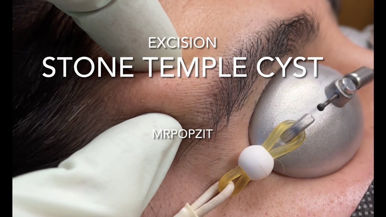 Stone Temple Cyst tug of war. Large calcified cyst on temple excision ...