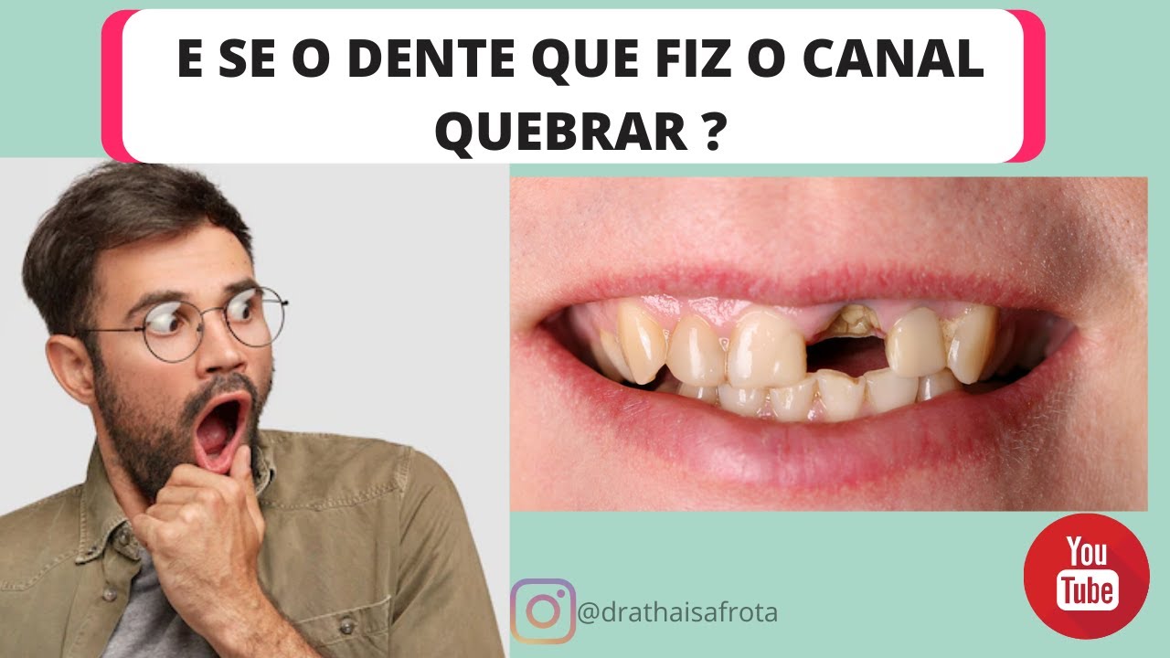 Meu dente quebrou depois de fazer canal, e agora ? - YouTube