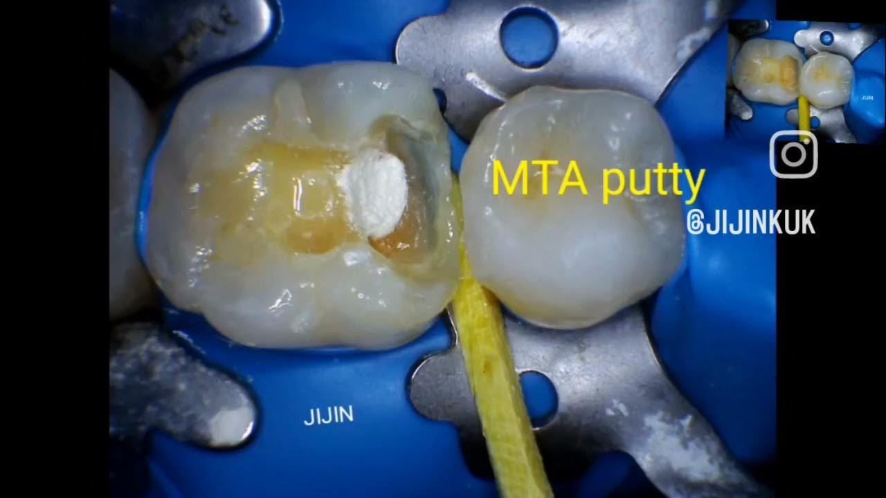 deep caries management using MTA putty. vital tooth . safe endo ...