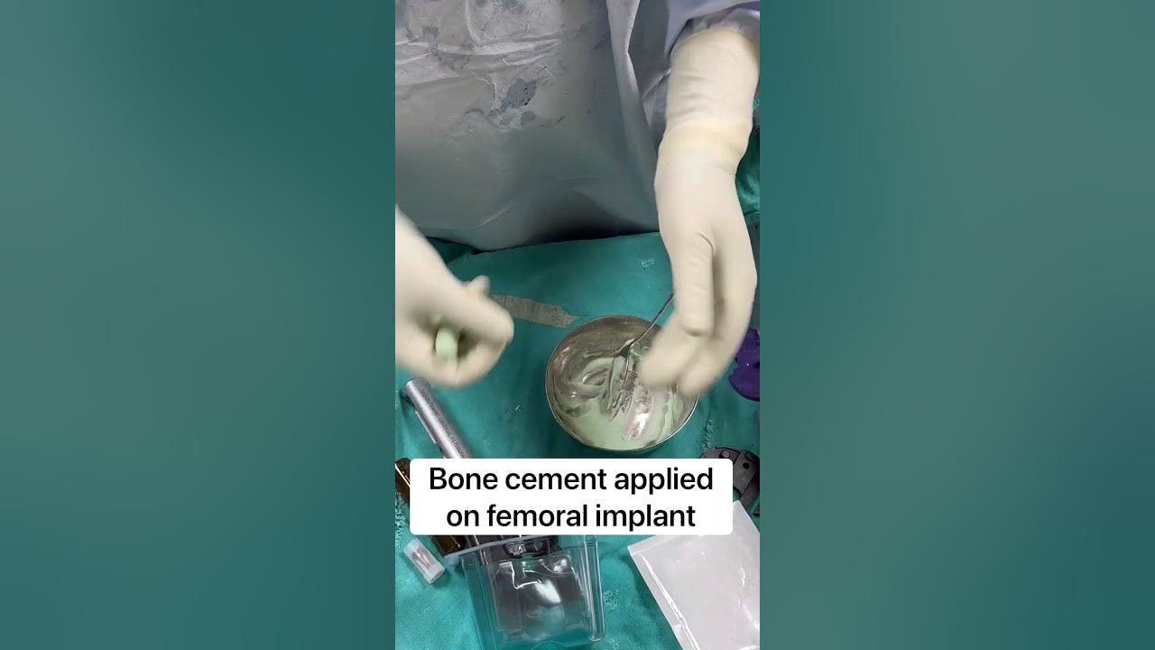 is-bone-cement-used-in-knee-replacement-shortsindia-kneereplacement