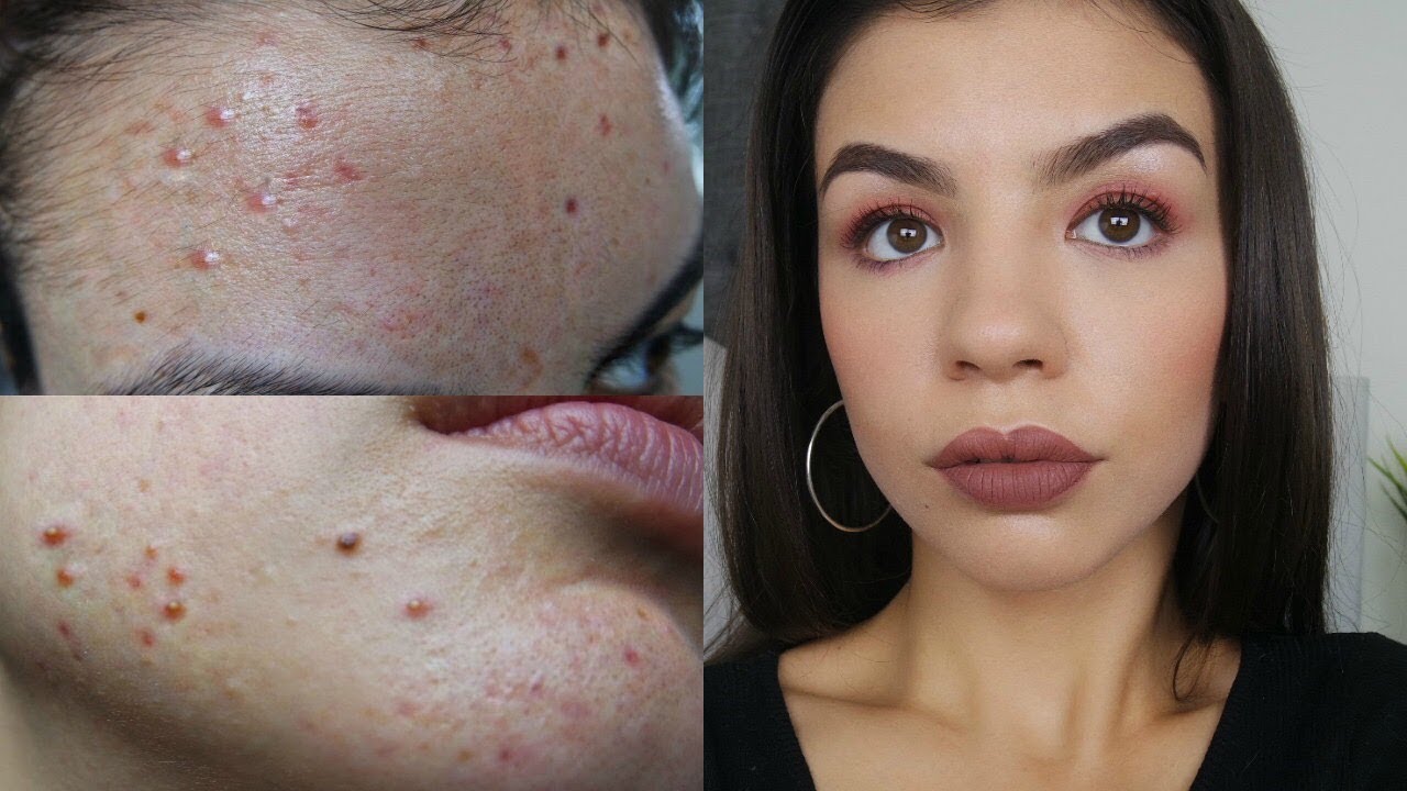 ACNE COVERAGE MAKEUP TUTORIAL AND FOUNDATION ROUTINE 2018 - YouTube