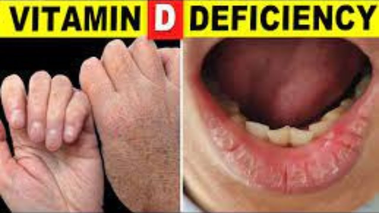 10 Signs Your Body is Craving Vitamin D: Are You Getting Enough Sun ...