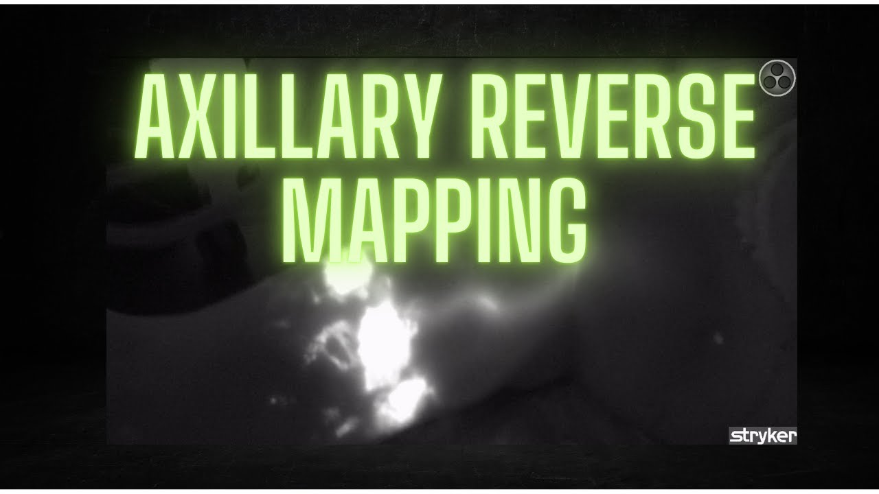 Axillary Reverse Mapping using ICG (Step by step) - YouTube
