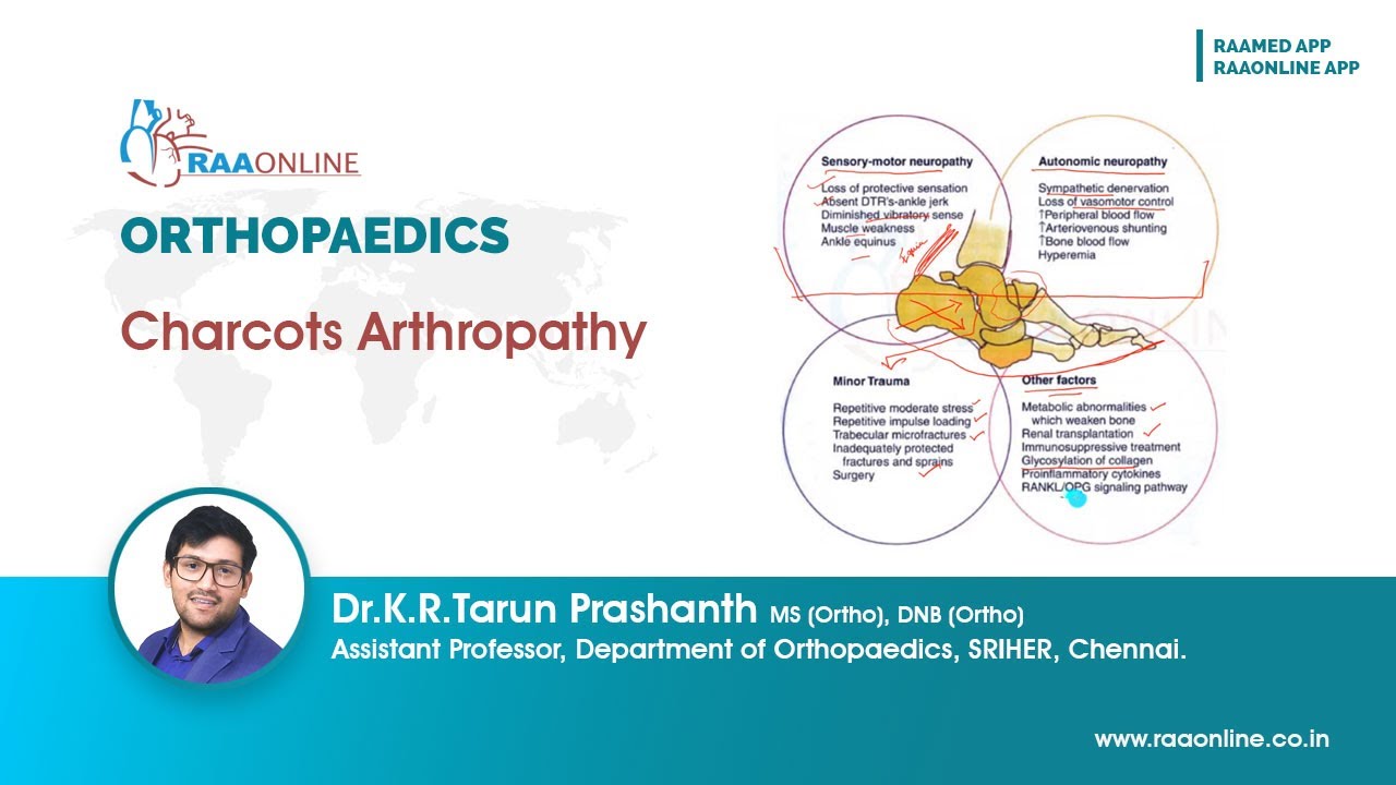 Charcots Arthropathy - YouTube