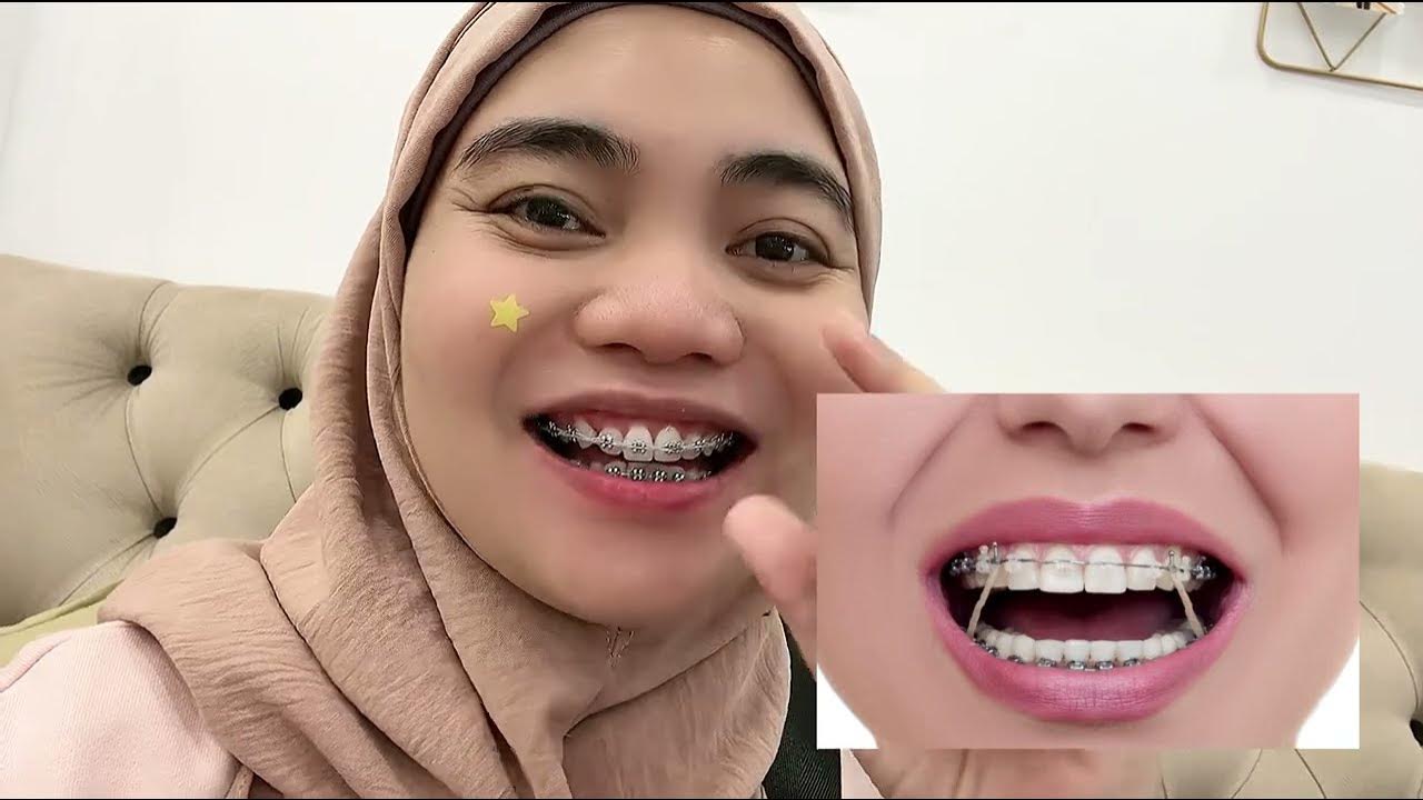 Braces update, tak lama lagi dah boleh bkk braces, yey!!!! - YouTube