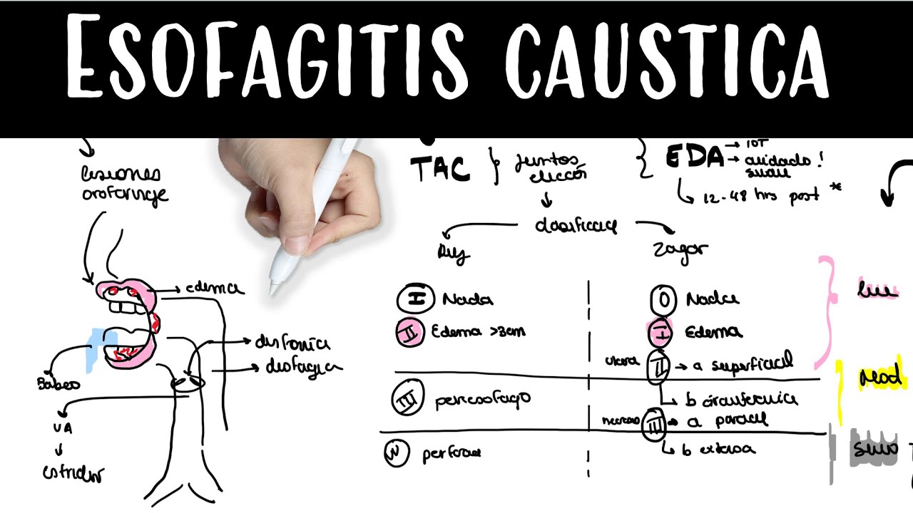 ESOFAGITIS POR CAUSTICOS #acidos #bases - YouTube