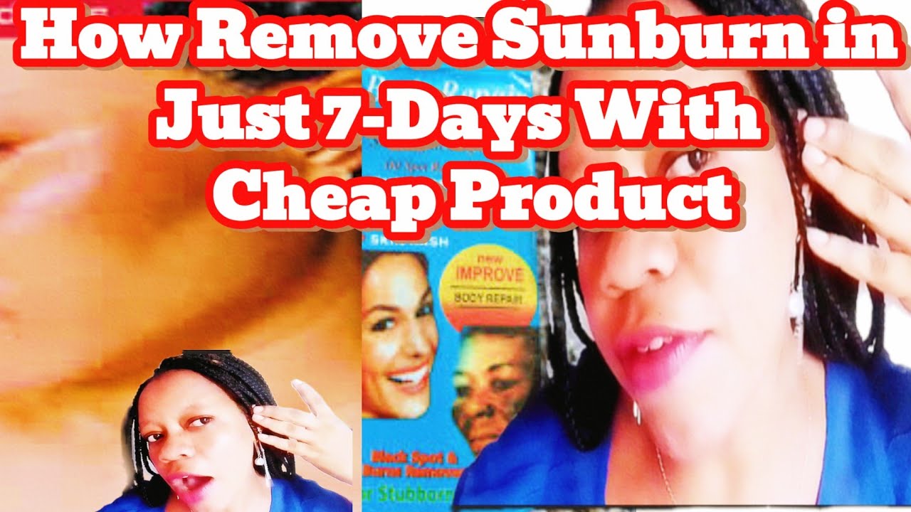 How To Remove Sunburn In Just 7-Days Permanently With Cheap and ...