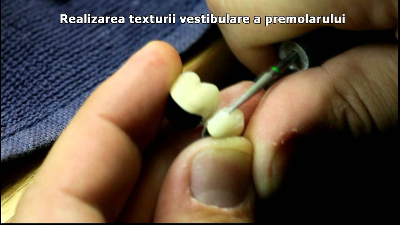 IPS InLine One egyrétegű fémkerámia - by Florin Stoboran - YouTube