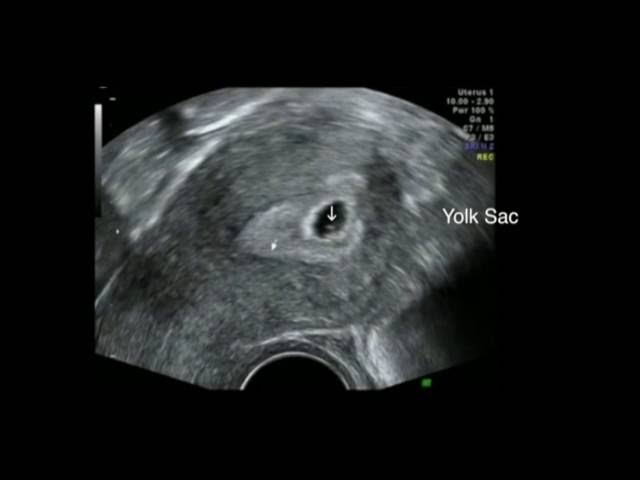 Yolk Sac 5 Weeks