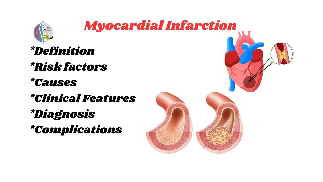 MYOCARDIAL INFARCTION | CAUSES | SIGN AND SYMPTOMS | DIAGNOSIS ...