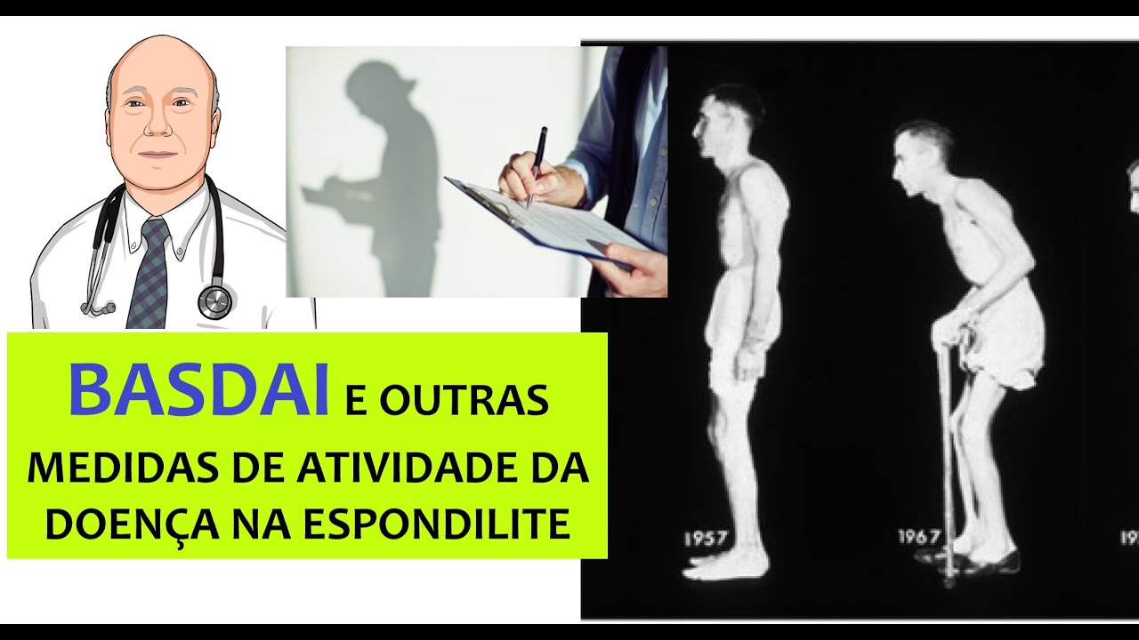 Métodos para aferir resposta ao tratamento na espondilite anquilosante ...