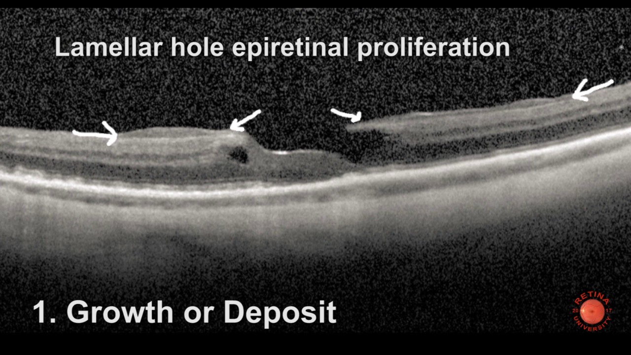 OCT line scan interpretation - Inner Retina - YouTube