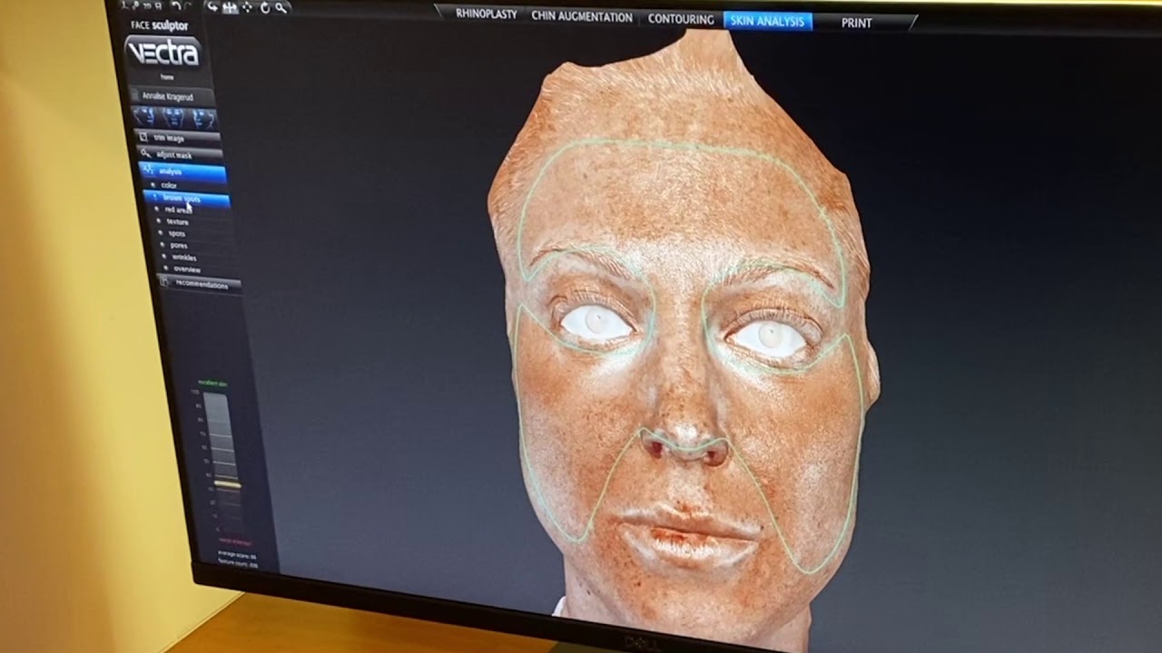 Photorealisitic 3D Plastic Surgery Simulation with Vectra H2 - YouTube