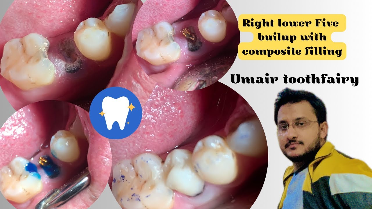 Right lower 5 buildup #dental #dentistry #smile #youtube # ...