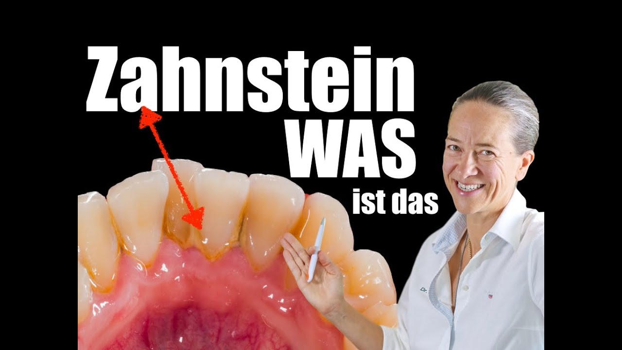 ZAHNSTEIN: WAS ist das? Was kann ich dagegen tun? - YouTube