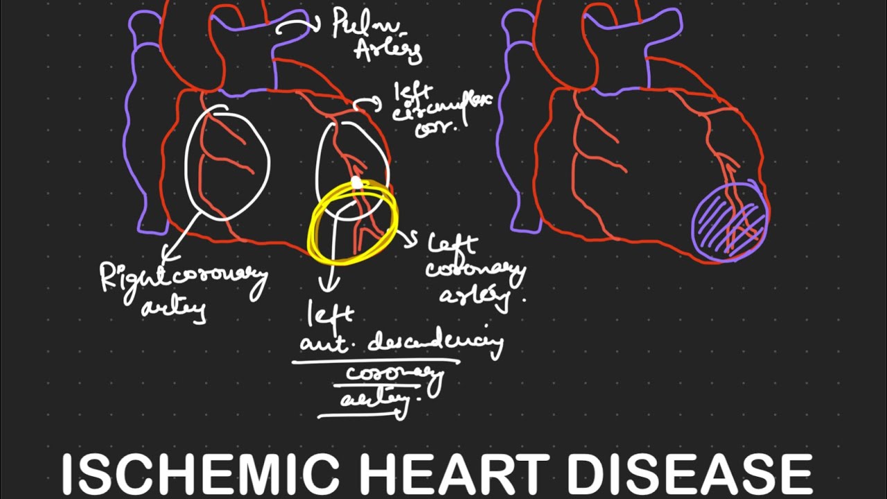 MYOCARDIAL INFARCTION- PATHOLOGY- ROBBINS PART1 - YouTube