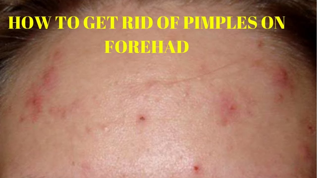 how to get rid of pimples on forehead overnight home remedies - YouTube