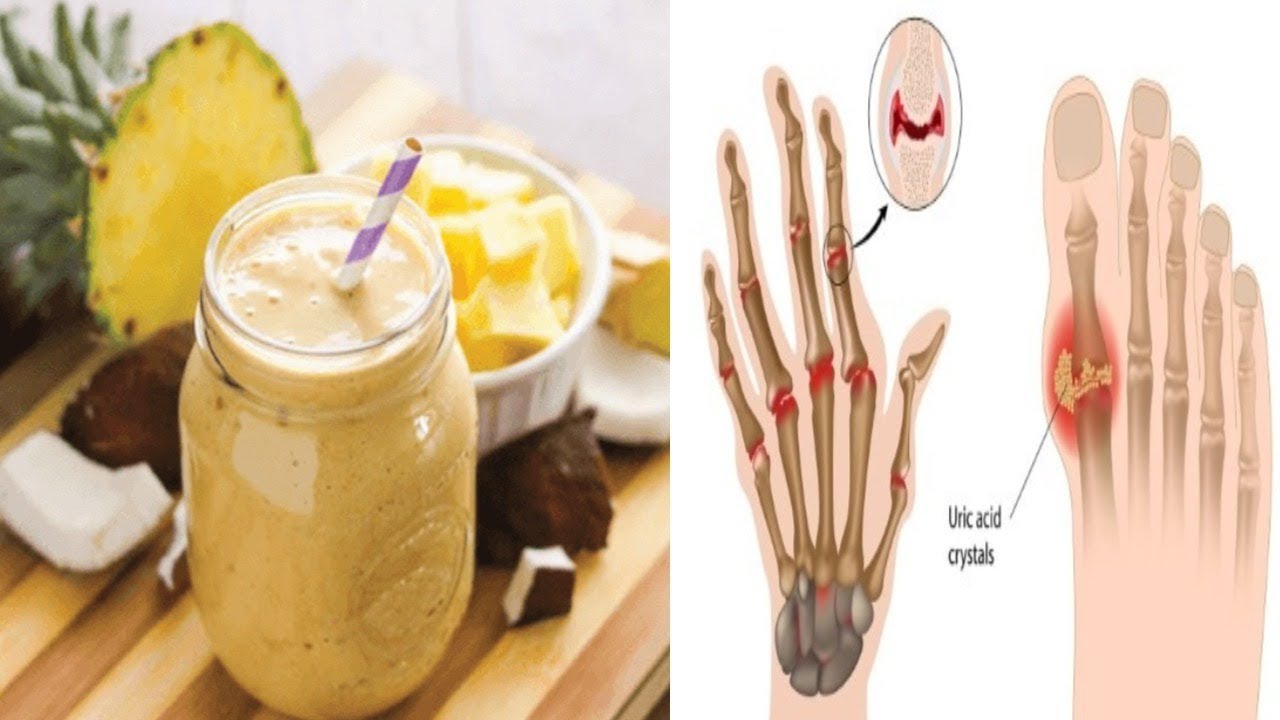 Say Goodbye To Gout Forever With This Powerful Natural Treatment Youtube
