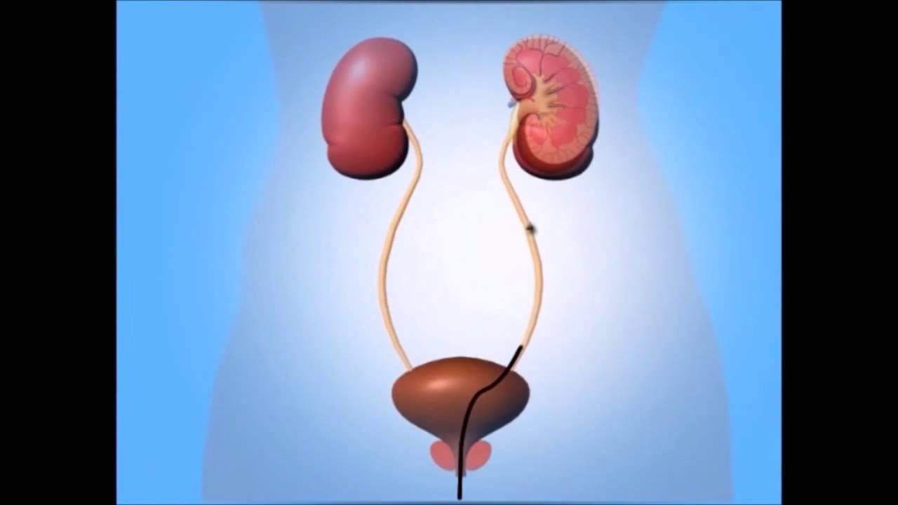 Ureteroscopy - Kidney Stone Treatment-hyderabad best urologist and ...