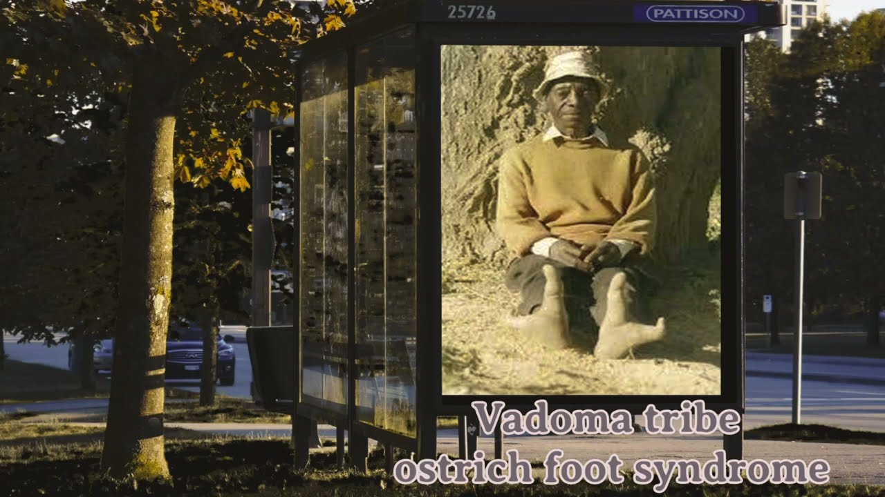 Vadoma Tribe Population The Ostrich Foot Syndrome. - YouTube