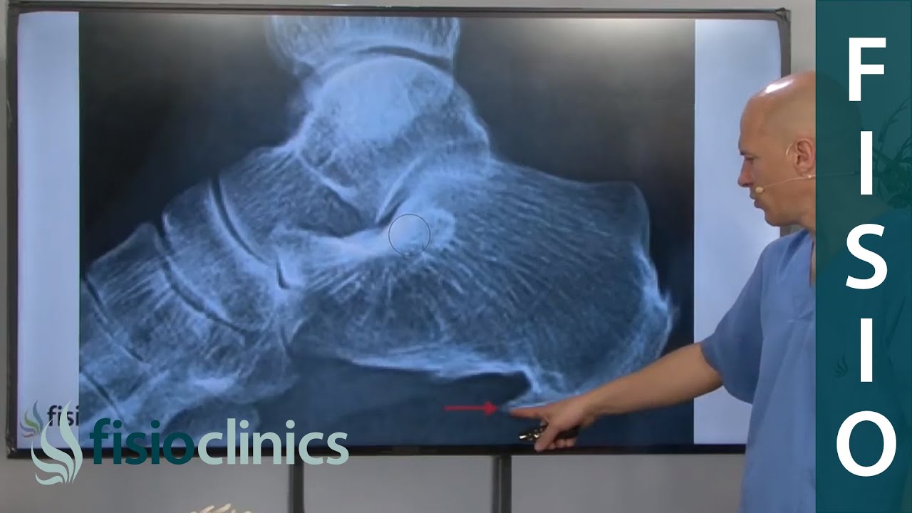 3 consejos para para curar un espolón calcáneo - FisioClinics Palma ...