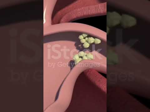 kidney Stones Animation - YouTube