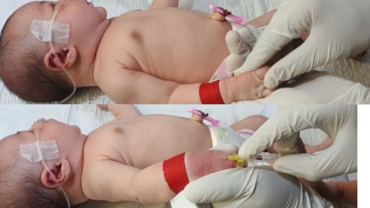 IV Line Procedure in Critical Baby with Severe Fits & O2 Support| NICU ...