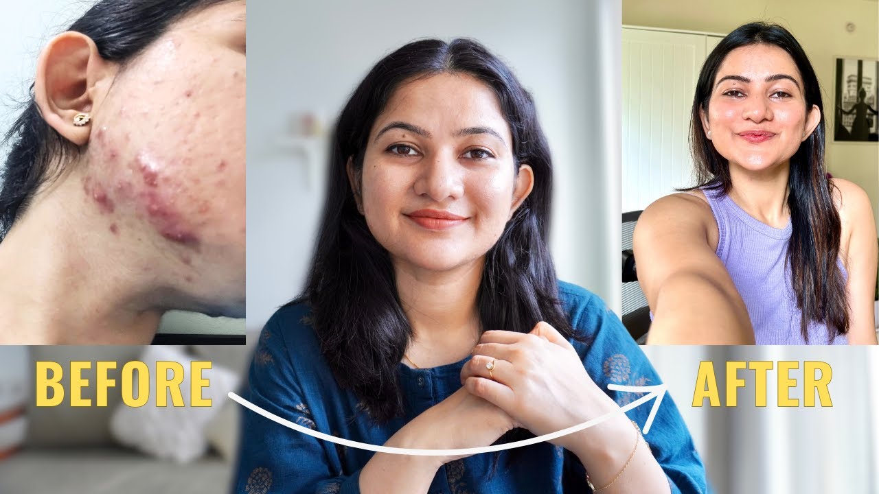 How I Detoxed My Body to Clear My Skin & Fix Acne Naturally |My Severe ...