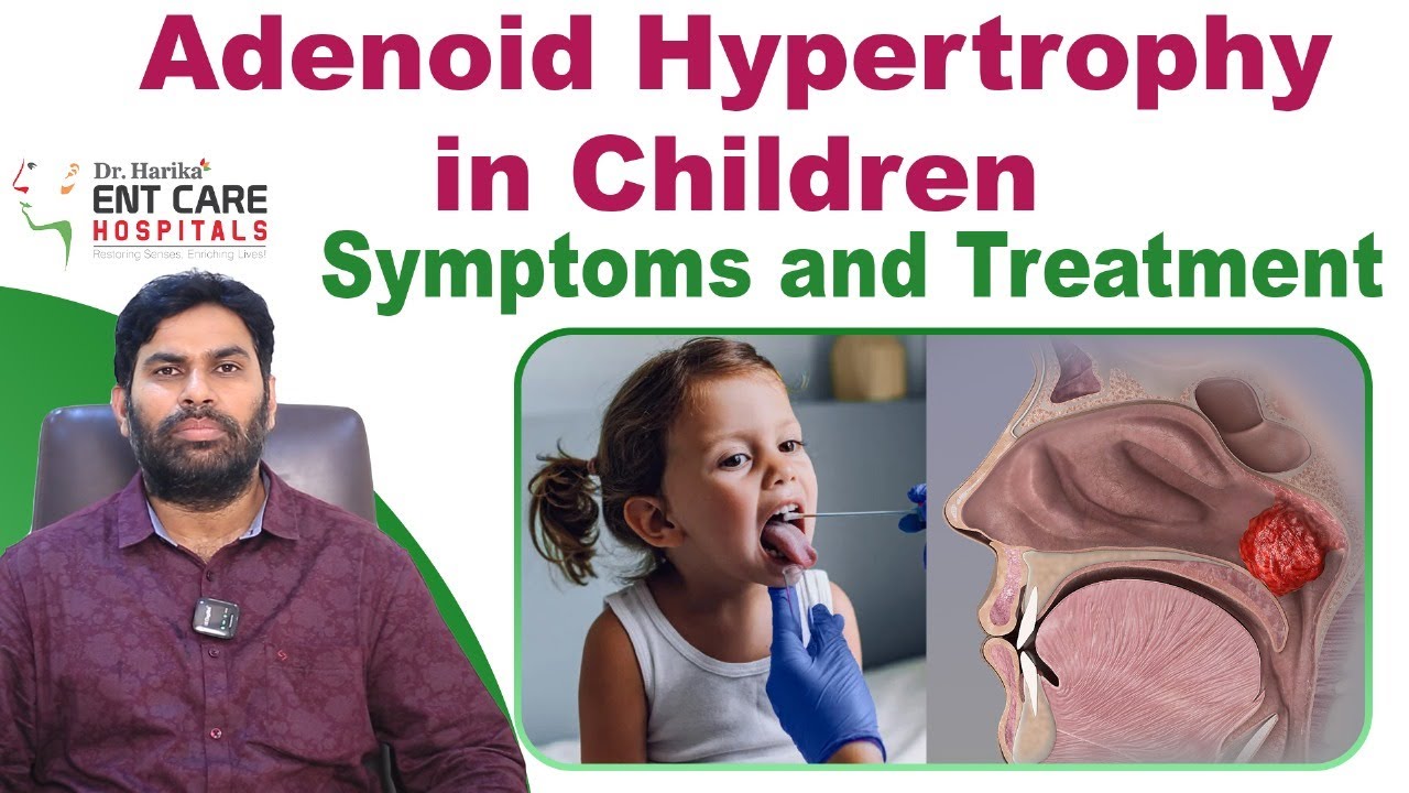 Symptoms and Treatment for Adenoid Hypertrophy in Children || Dr Harika ...