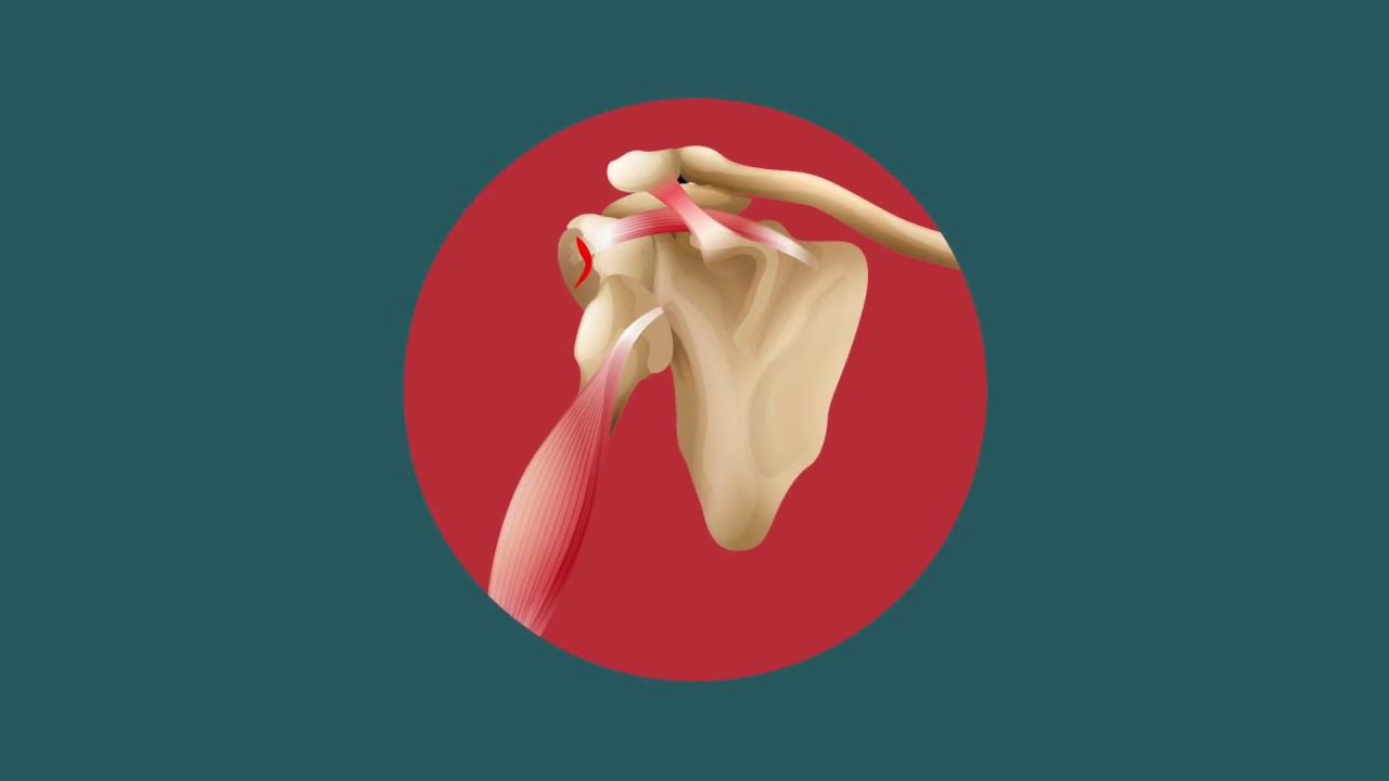 Descriptive Epidemiology of the MOON Shoulder Instability Cohort - YouTube