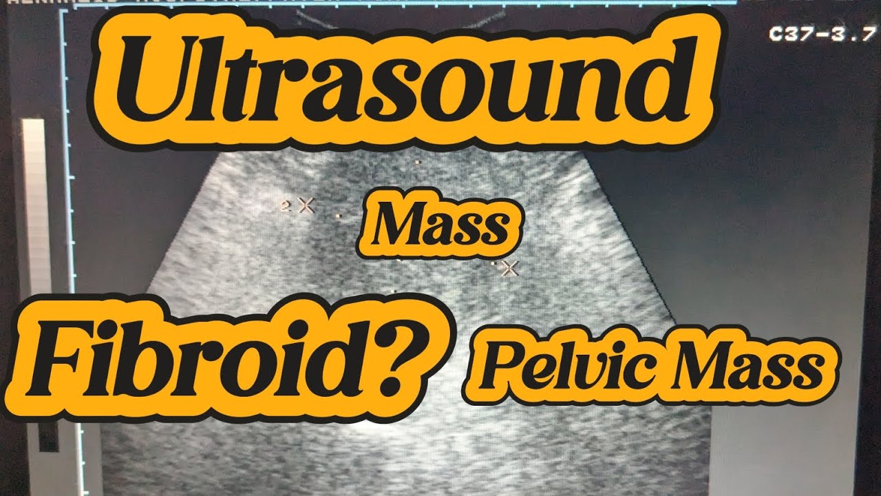 From Imaging to Diagnosis: The Role of Ultrasound in Pelvic Masses ...