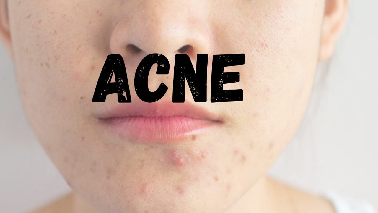 Acne symptoms ,causes ,treatment and complications #acne_vulgaris #skin ...