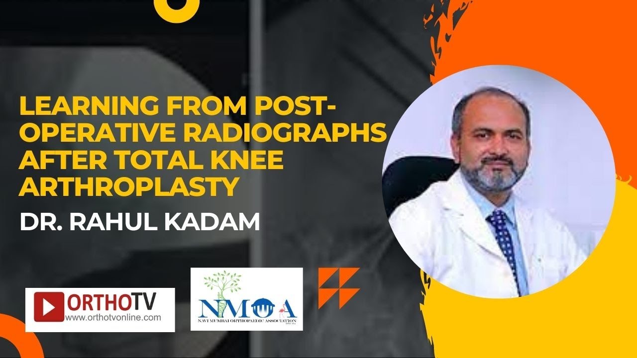 NMOACON 2022 :Learning from Post-operative Radiographs after Total Knee Arthroplasty-Dr. Rahul ...