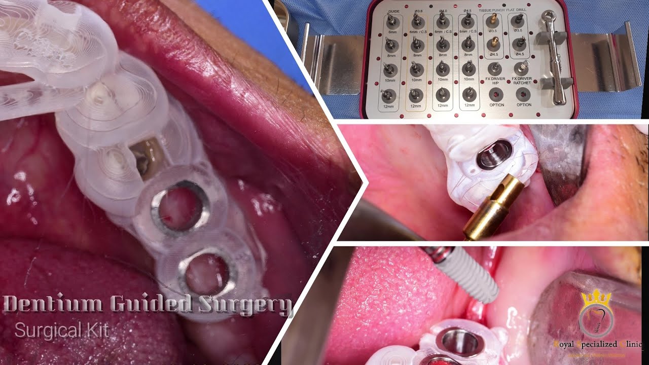 Fully guided implant surgery by using Dentium Implant System - YouTube