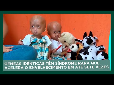 Gêmeas idênticas têm síndrome rara que acelera o envelhecimento em até sete vezes | Dom Espetacular
