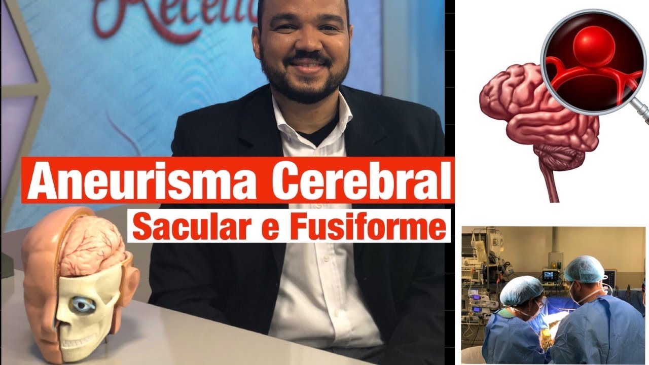 Aneurisma cerebral: Sacular e fusiforme - YouTube