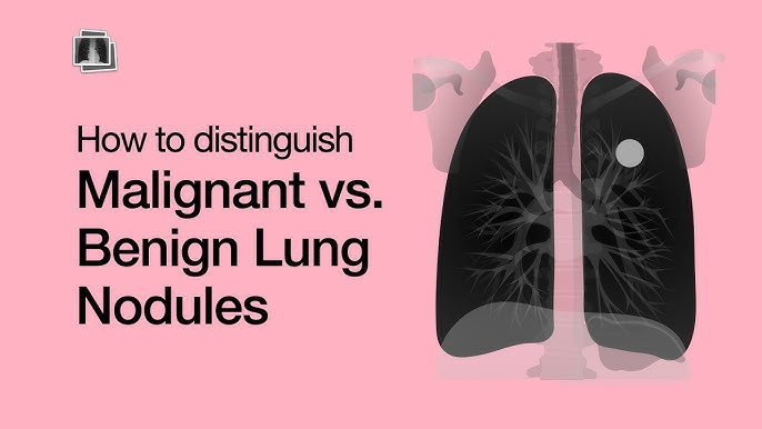 Benign Lung Tumor