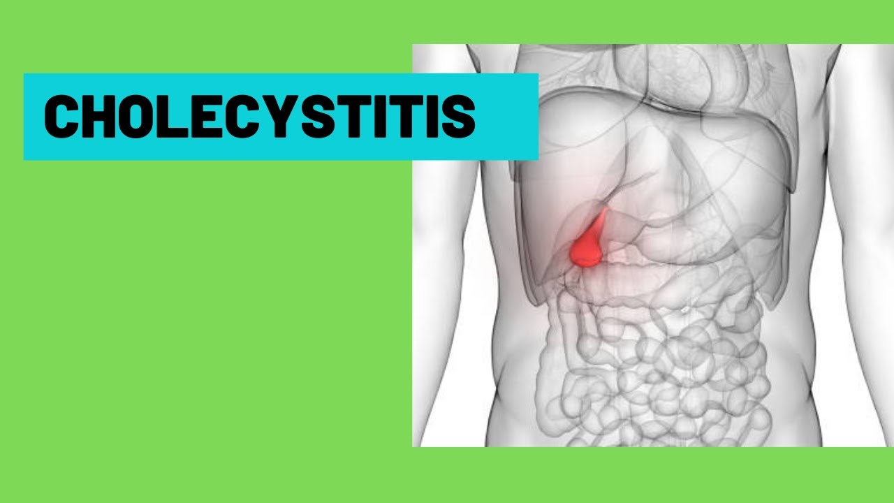 Cholecystitis | Acute cholecystitis | Murphy's sign | Signs / symptoms ...