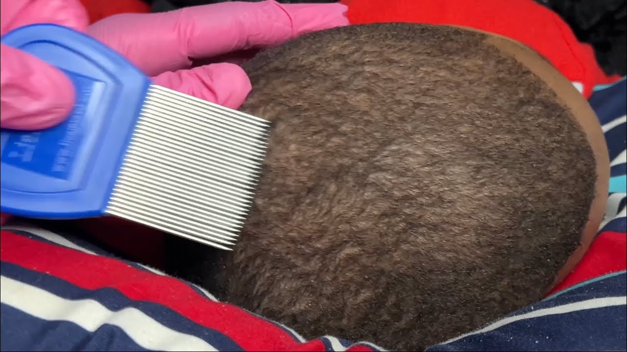 ASMR | dandruff scratching eczema relief scalp scratching - YouTube