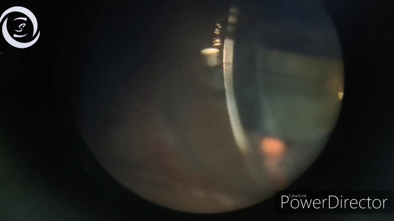 Van herick method - YouTube