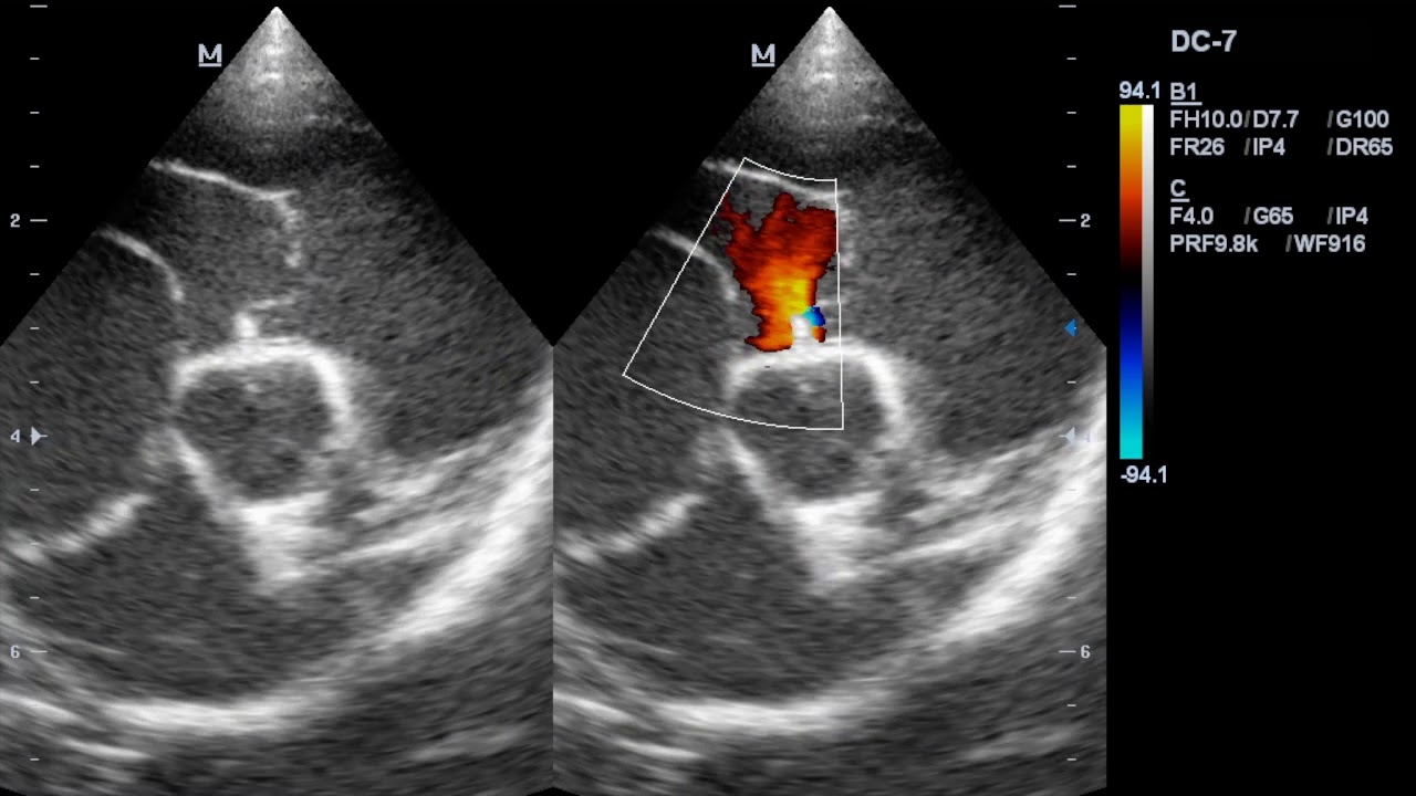 Cor triatriatum dexter. - YouTube