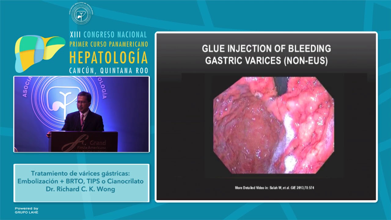 Curso Endoscopia - Tratamiento de várices gástricas: Embolización ...
